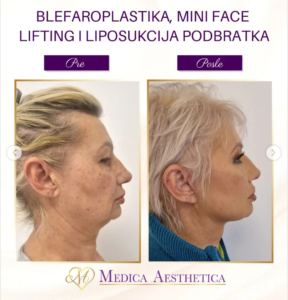 Liposukcija podbratka - Medica Aesthetica